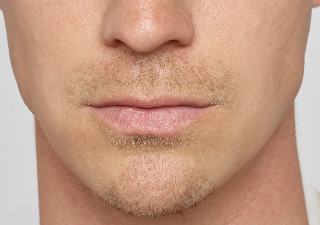 Jawline operation in Bonn | Dr. Jorjani Aesthetics